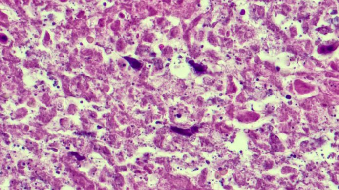 skinnontumorleishmaniasisCazzatoIngravallo04 | Jacinto Convit World ...